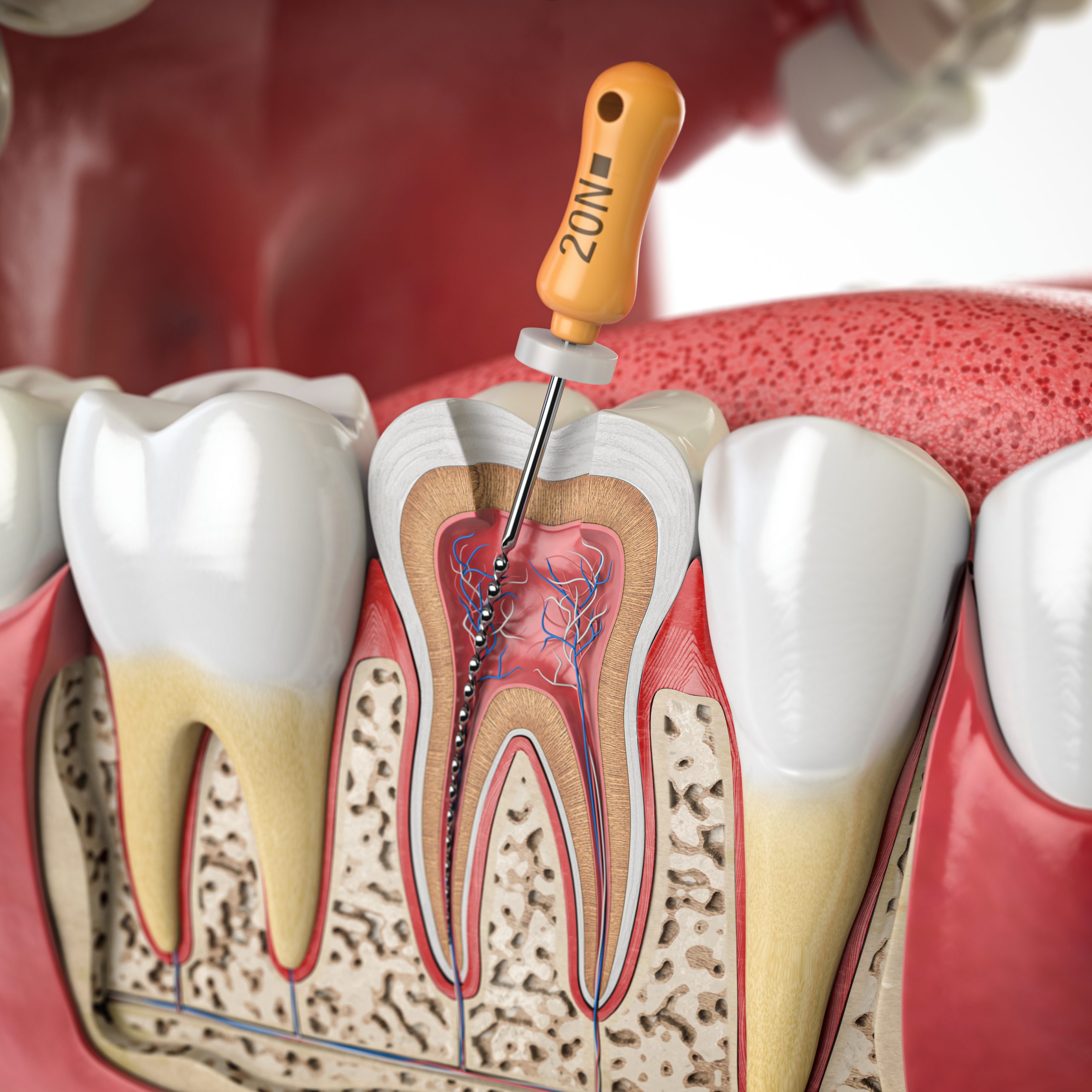 Las ventajas de la endodoncia. Conserva tu sonrisa y tu salud oral | SieroDental